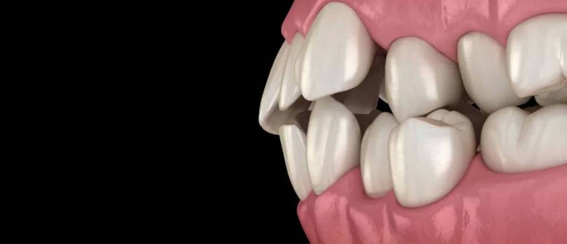 Should I Fix My Crooked Teeth - Perfect 32 Family Dentistry